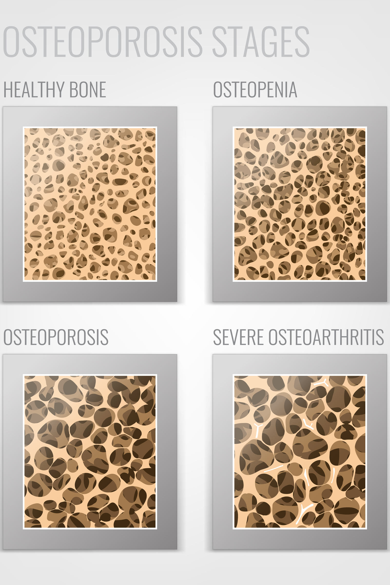 Osteoporosis - Nutritional Therapist, Tavistock, Devon and the South ...