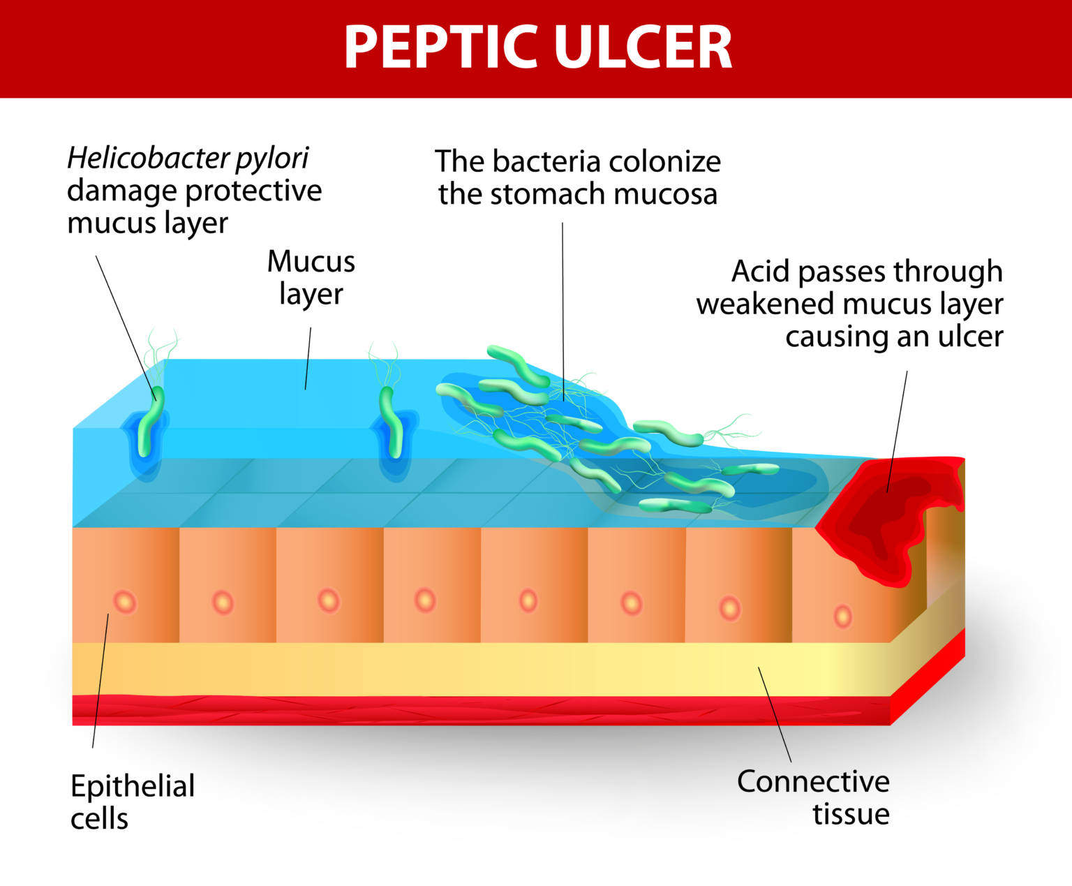 Peptic Ulcers - Nutritional Therapist, Tavistock, Devon and the South ...